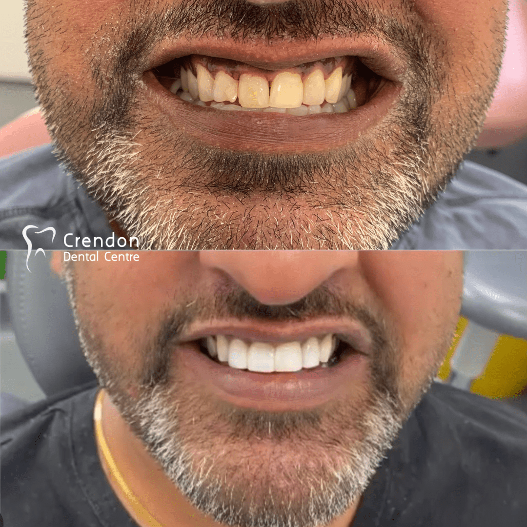 Composite Fillings | Dentist High Wycombe | Dental Implants